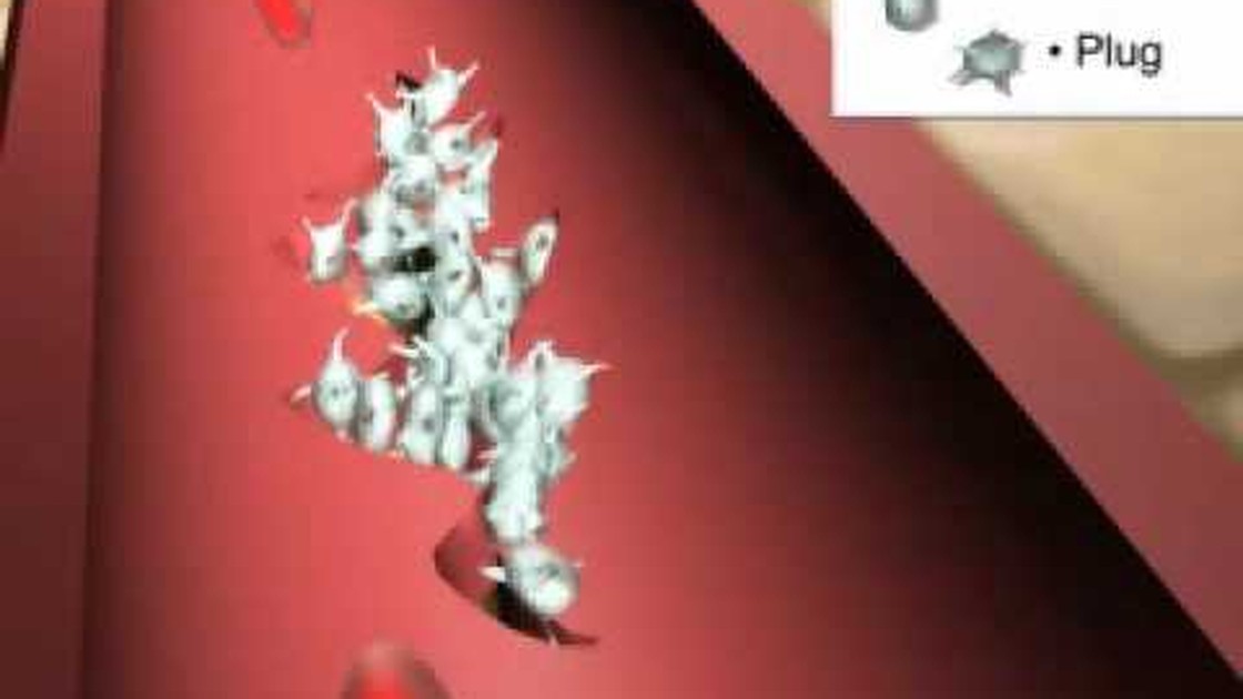 Blood Clotting to the Rescue: How to Stop Too Much Blood from Flowing ...